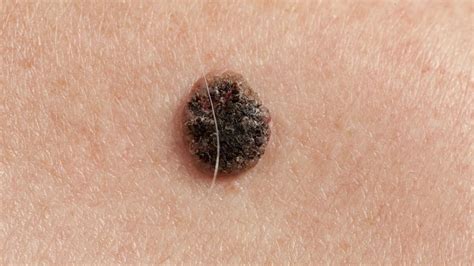 HPV 疫苗 Gardasil 成功治療女性皮膚癌