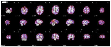using neural networks for a functional connectivity classification of fmri data by gelana