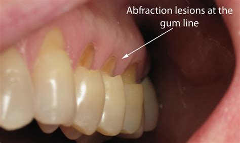 Abfraction News Dentagama