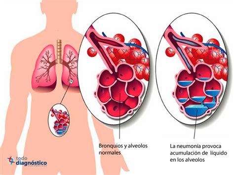 Cuáles son las causas de la neumonía y los tipos de neumonía