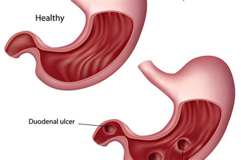 Gastric Ulcer Khichdi Network Portal