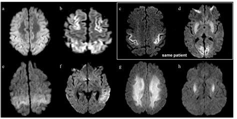 Radiological Findings In Hypoxic Ischaemic Encephalopathy Deranged