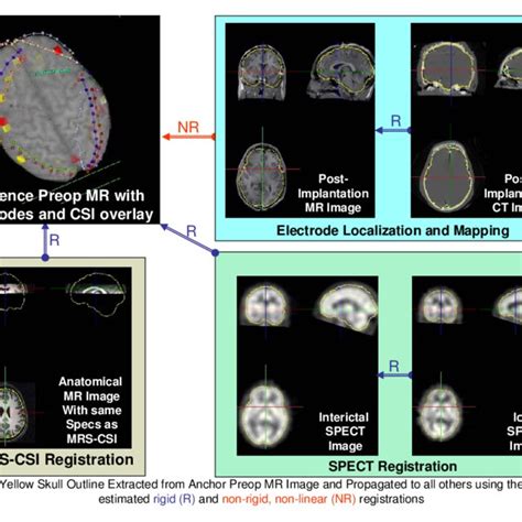 applications of rigid and nonrigid registration in neurosurgical download scientific diagram