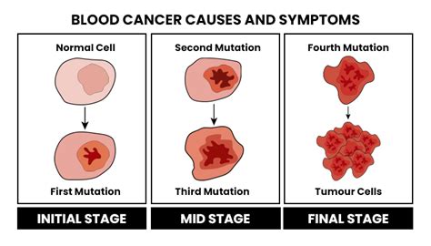 Blood Cancer Types Symptoms Causes And Its Treatment