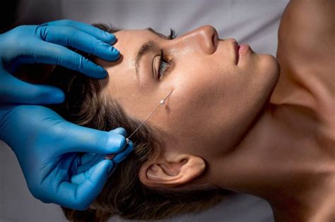 Los Hilos Tensores Rejuvenecen El Rostro Con Cero Invasi N Ser