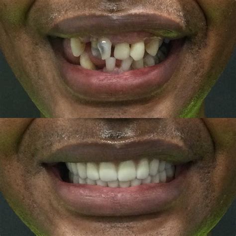 All On 4 Dental Implants Before And After