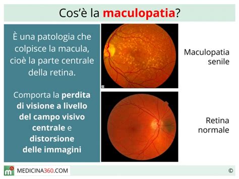 Maculopatia Tipi Cause Sintomi Cure E Rimedi Naturali
