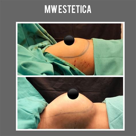 Aumento mamas Antes y después Esteticas ar Esteticas ar