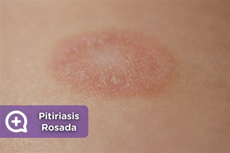 Erupciones En La Piel Todo Lo Que Debes Saber Sobre La Pitiriasis