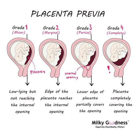 What Is Placenta Previa Milky Goodness