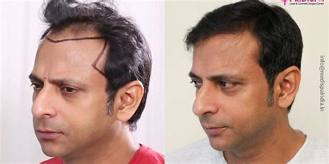 Celebrity Hair Transplant Before And After