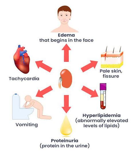 Causes Of Nephrotic Syndrome Medizzy