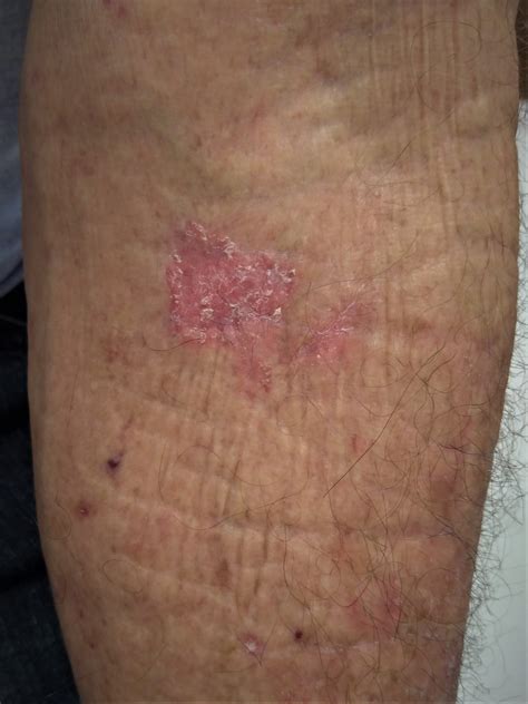 UVA e UVB como cada tipo de radiação ultravioleta afeta a sua pele
