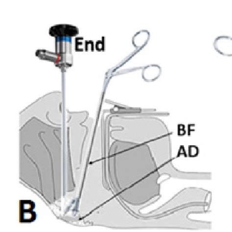 A Preoperative View Of Large Adenoids Ad Picture Was Inverted Upside