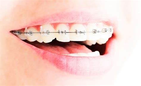 Como se ponen los brackets Clínica Dental Jose Luis Cano Rueda