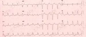 Qué es un bloqueo de rama izquierda en un electrocardiograma Haras