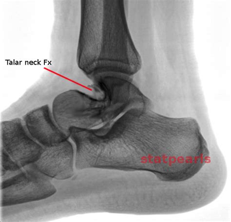 Figure Talar Neck Fracture Image Courtesy Of S Bhimji MD