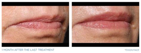 Lip Fillers Perth Lip Injections Enhancement MIRA Clinic