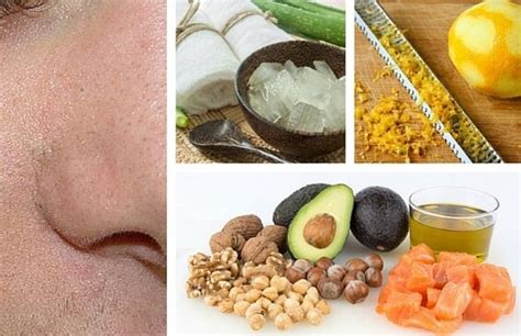 Introducir 83 Imagen Recetas Para Quitar Los Puntos Negros De La Nariz