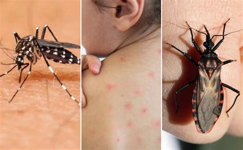Dengue chagas y sarampión Los brotes silenciosos Noticias UNSAM