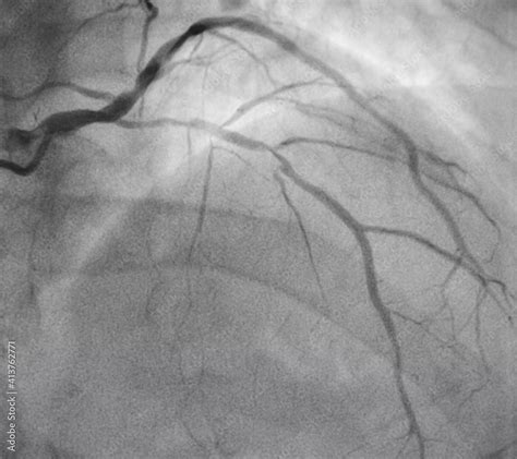 Coronary Angiogram Medical X Ray For Heart Disease Coronary Artery