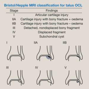 Hepple Mri Staging Classification For Osteochondral Lesions Of The