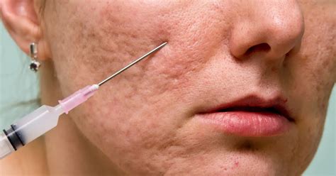Tudo sobre Cicatriz de Acne Cremes Ácidos Procedimentos e Tipos