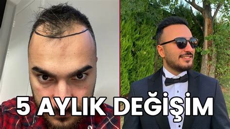 Saç Ekimi sonrası 5 ay nasıl geçti YouTube