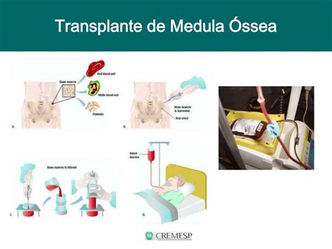 Ppt Transplante De Medula Ssea Powerpoint Presentation Free