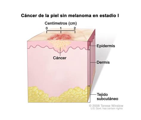Sintético 92 Foto Como Detectar Cáncer De Piel Fotos Lleno