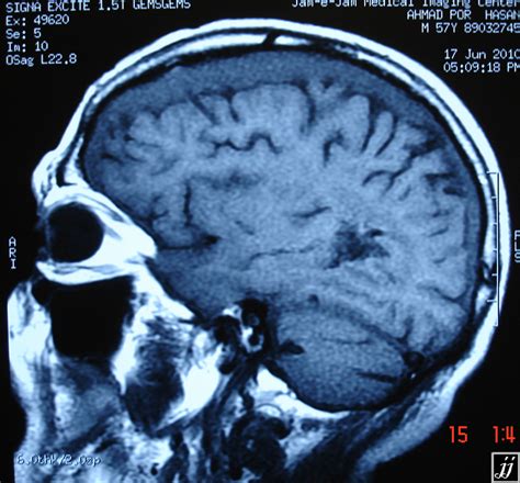 Brain Craniopharyngioma Phosphorous Injection And Shunt Subdural