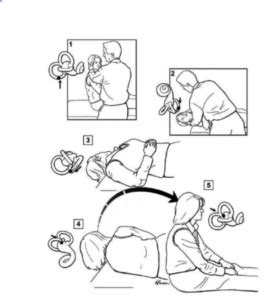 Modified Epley Maneuver Update Bppv Treatment