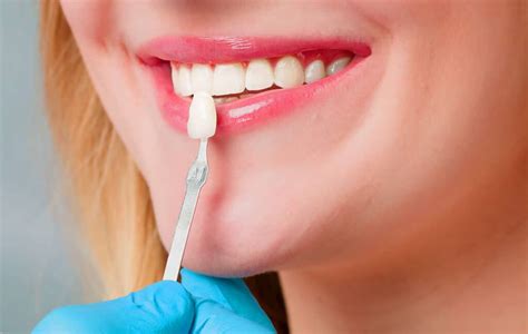 Manutenção de lente de contato dental Entenda como funciona a