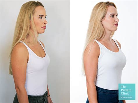 Breast Enlargement Surgery London Breast Implants UK Cost Before And