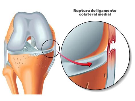 LESÃO DO LIGAMENTO COLATERAL MEDIAL LCM Dr Rodrigo Medeiros Ortopedista