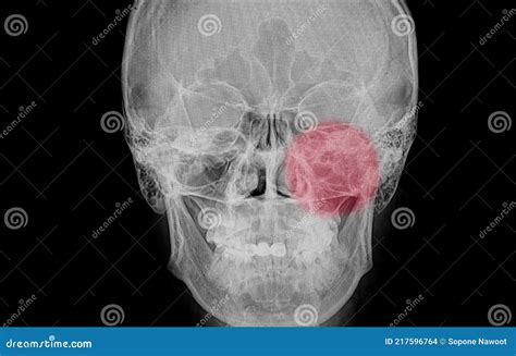 Acute Sinusitis X Ray