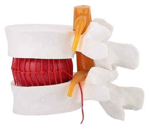 Buy Anatomy Model Human Anatomy Spine Lumbar Disc Herniation Model