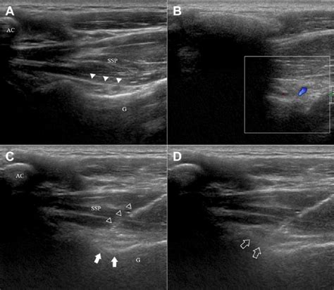 Anterior Suprascapular Nerve Block