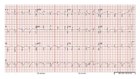 EKG Showing Sinus Rhythm With Right Bundle Branch Block Left Anterior