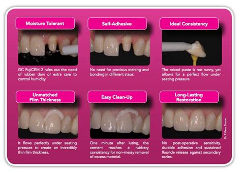 Zirconia Crowns Cementation