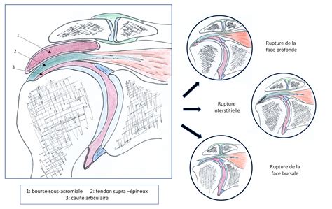 Pathologie De La Coiffe Des Rotateurs Docteurs Bourgade Et Tavernier