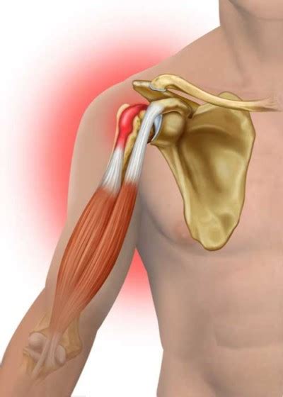 Biceps Tendon Tear Shoulder Specialist Van Nuys Westlake Village