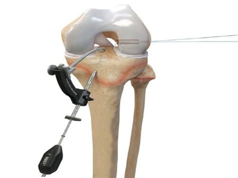 Arthrexs TightRope Implant USA
