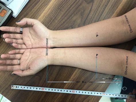 Location Of The Perforator Of The Radial Artery In The Proximal