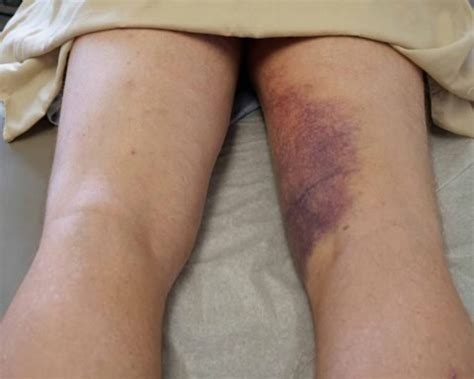 Cómo tratar un desgarro muscular desde la fisioterapia
