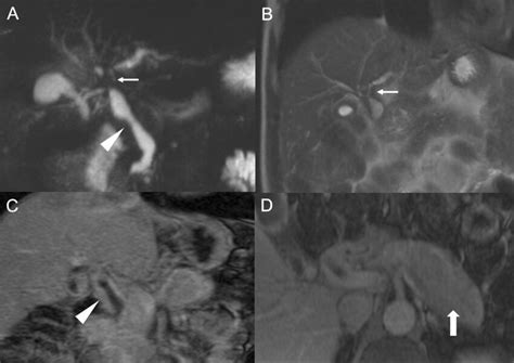 IgG4 Related Sclerosing Cholangitis In A 59 Year Old Man With