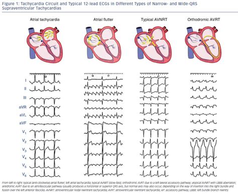 Ventricular Tachycardia