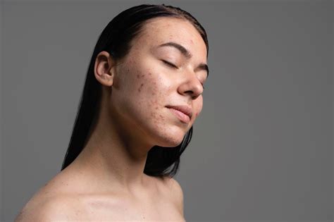 Acne Na Mulher Adulta Saiba As Principais Causas E Como Tratar