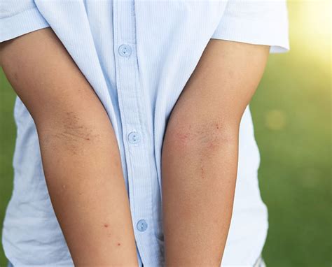 Eczéma des bras Fondation Eczéma