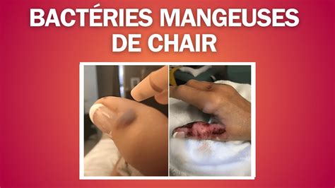 La DANGEREUSE bactérie MANGEUSE de chair Vibrio Vulnificus YouTube